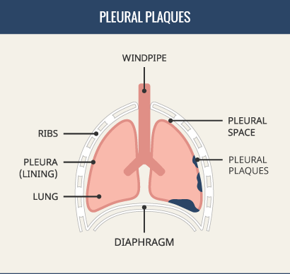 Claim Compensation for Pleural Thickening in Scotland