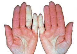 Vibration White Finger | Thompsons Scotland